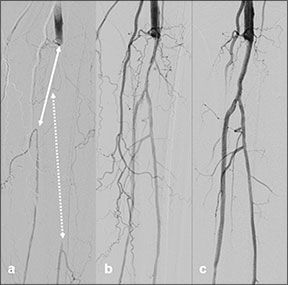 Exercise May Improve Quality of Life for PAD Patients - Heart Advisor