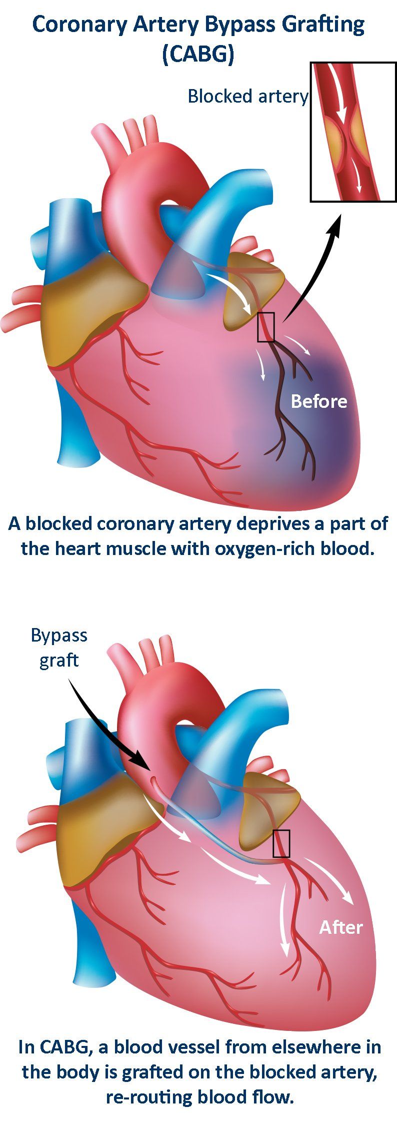 Coronary Artery Bypass Surgery in Women - Heart Advisor