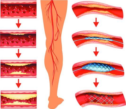 Revascularization More Effective Than Exercise Alone for PAD - Heart ...