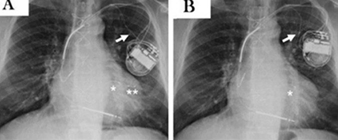 Study: Removing Nonfunctioning ICD Leads Safer in the Long Run - Heart ...