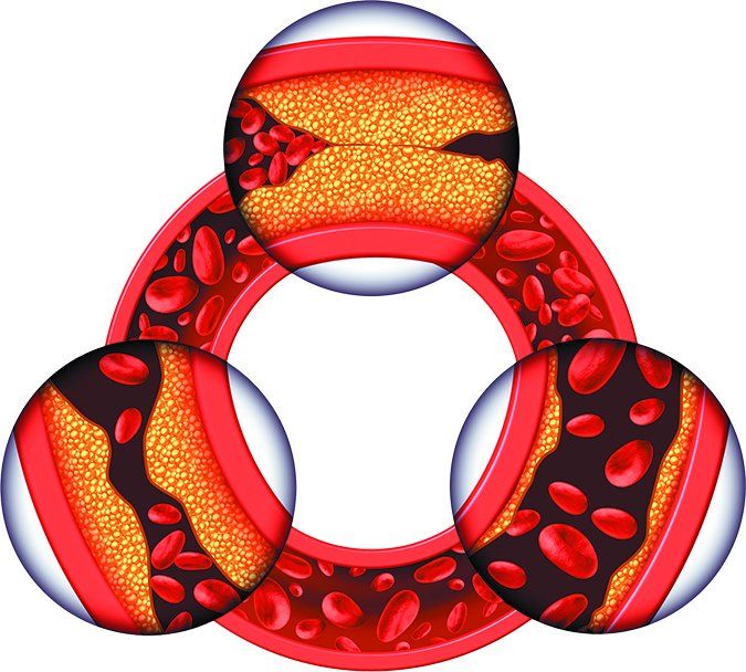 Injectable Cholesterol-Lowering Drug Continues to Show Promise - Heart ...