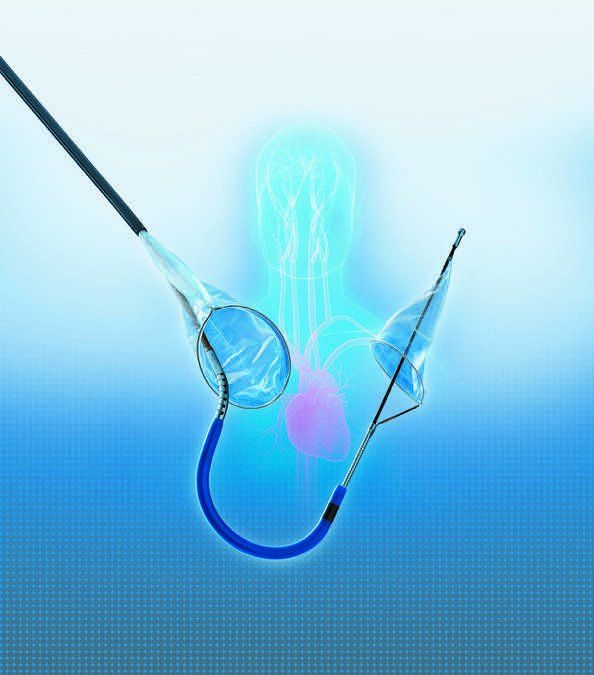 Stroke Protection Device Makes Aortic Valve Surgery Safer - Heart Advisor