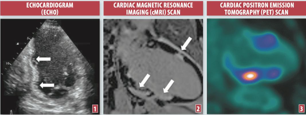 Several Tests Used to Diagnose Infiltrative Cardiomyopathies - Heart ...