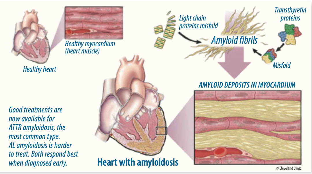 New Treatments Improve the Prognosis for Cardiac Amyloidosis - Heart ...